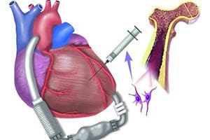 Injection of marrow stem cells into the heart is proven ineffective ...
