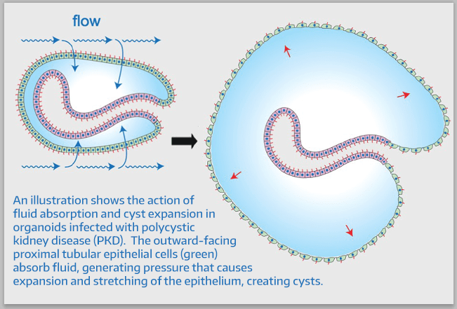 Discovery About a Common Cause of PKD Could Have Clinical Implications